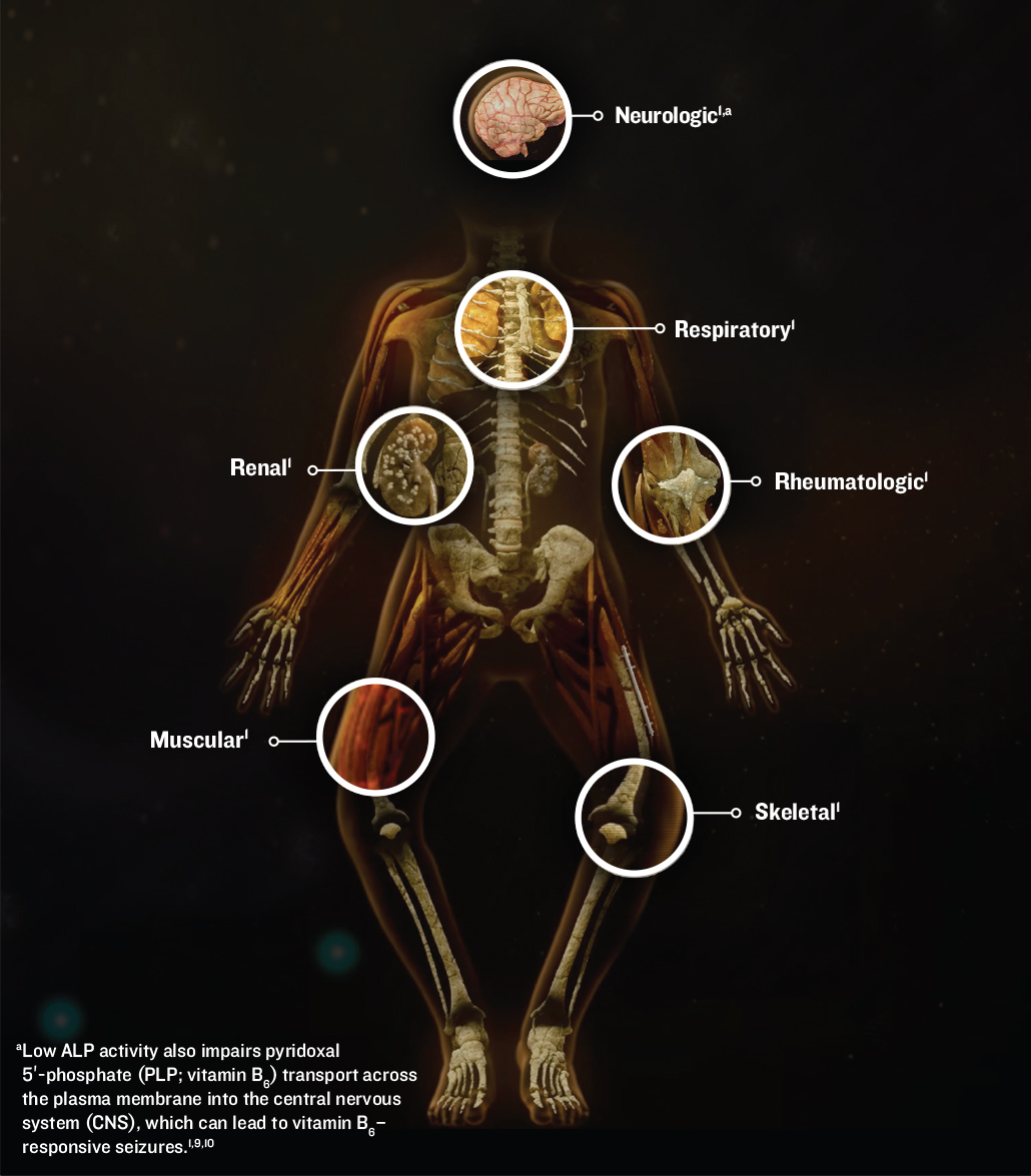 Mortality Risk For Hypophosphatasia Mortality Risk For Hypophosphatasia